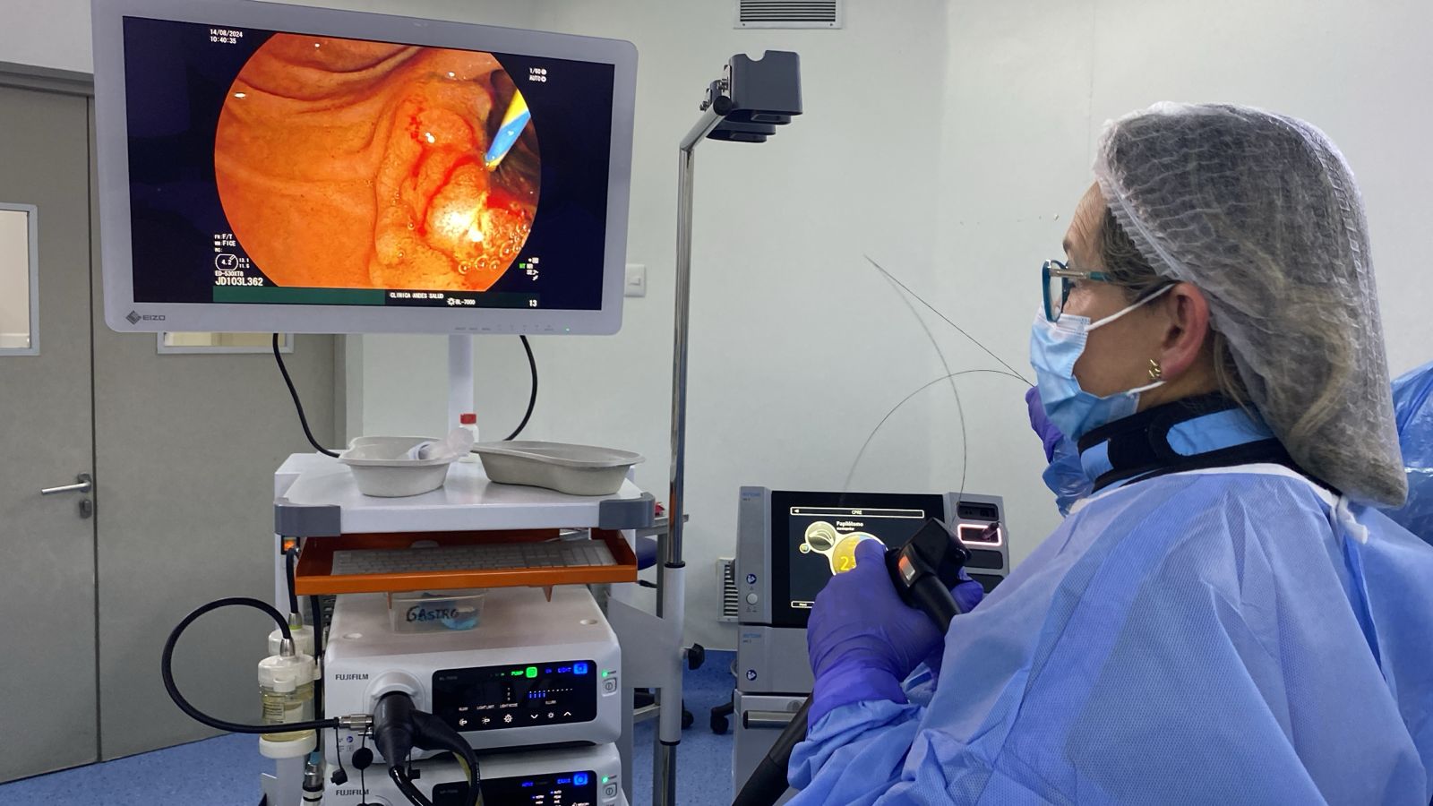 Colangiopancreatografía Retrógrada Endoscópica